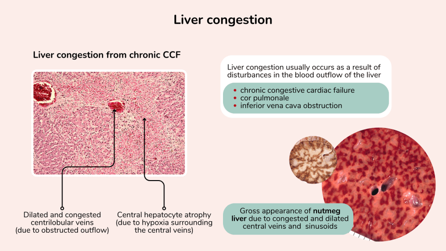 Fluid homeostasis and oedema – Blood & Water