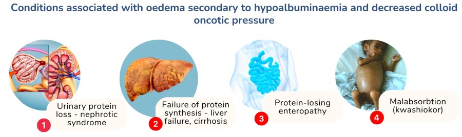 Fluid homeostasis and oedema – Blood & Water